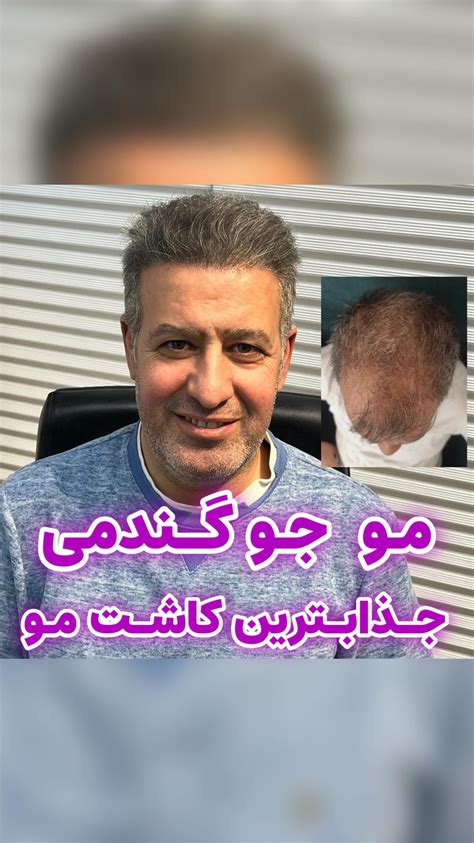 ‎کلینیک عالی‌رخ رتبه یک تراکم کاشت مو ایران🥇‎ ‎😍کاشت مو جو‌ گندمی😍