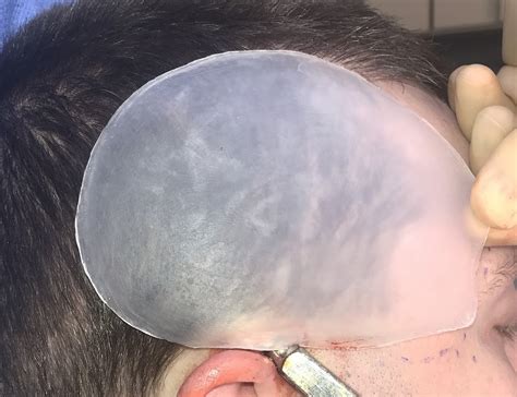 Custom Temporal Implants Placed On Patient Intraop Dr Barry Eppley Indianapolis Explore