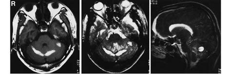 Axial T 1 Weighted Left Axial T 2 Weighted Center And Sagittal