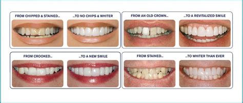 Dental Veneers Guide On Dental Veneer Prices Risks And Photos