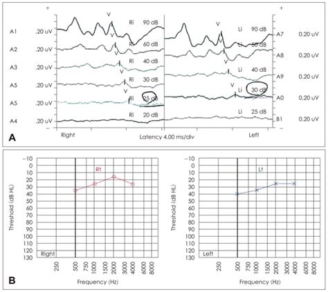 Acoustic Brainstem Response Threshold Abrt And Auditory Steady State