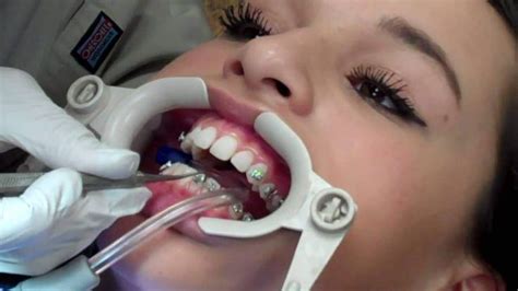 What Are The Steps Of Getting Braces Process Of Getting Braces