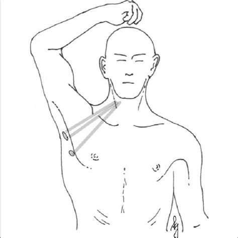 Pdf From Four Parathyroid Gland Exploration To A Minimally Invasive