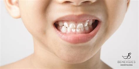 Manchas Nos Dentes Quais As Principais Causas