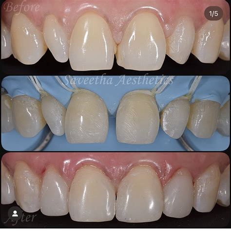Peg Lateral Correction Using Direct Composite — Department Of Aesthetic