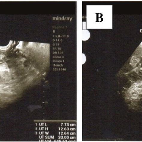 A Gross Morphology Of The Fibroid Specimen Taken Out From The