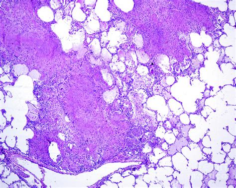 Tuberculosis Granuloma In Human Lung 1 Photograph By Jose Calvo