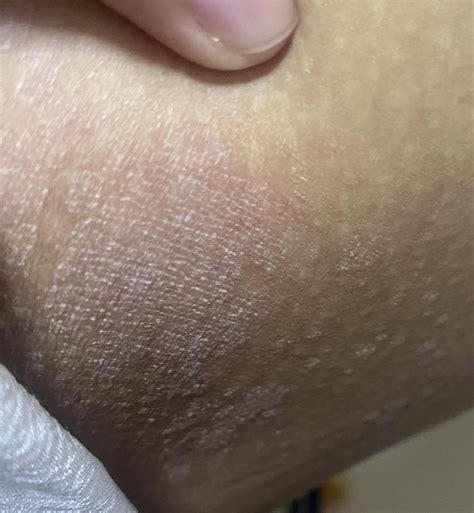 Hi What Is This White Dry Patches Near My Private Parts R