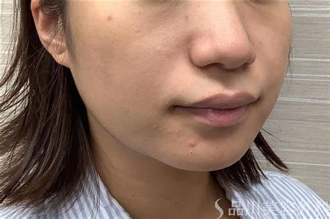 上野院 千葉医師による美肌アモーレ（プラチナ） スキンクリニック上野院 品川美容外科 症例サイト