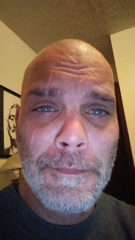 Everyone Thinks An Eye Scar Is Cool Untill You Get One Awesome Eye Scar Face Scars Scar