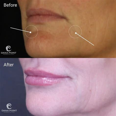 Botulinum Toxin Injections Women Before And After Dana Point