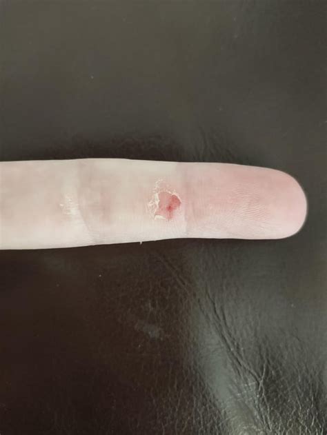 Unknown Skin Conditionbump On Finger Rdermatologyquestions
