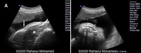 📃 Thanatophoric Dysplasia A Case Report