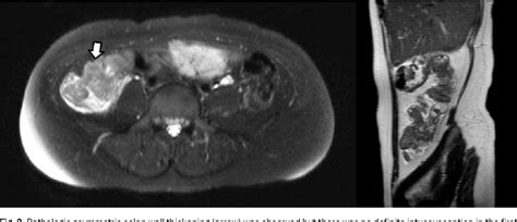 Figure 1 From Intussusception Caused By Colon Cancer In Pregnancy