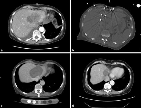 63 year old female patient with inoperable intrahepatic download