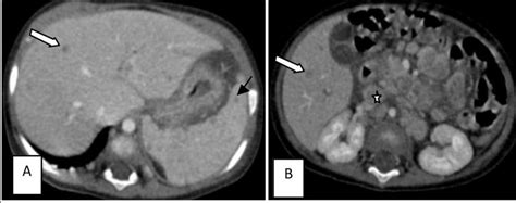 Abdominal Ct Scan Showing Disseminated Bcg Infection In A Patient With