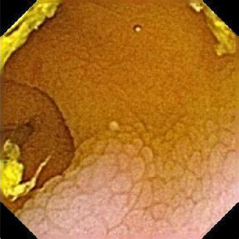 Vce Nodularity Of The Jejunal Mucosa With Absent Folds Download