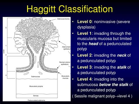 Ppt Malignant Rectal Polyp Powerpoint Presentation Id432580