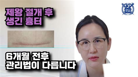 제왕절개 보톡스 흉터 초기에 집에서 쉽게 관리하는 방법 Youtube