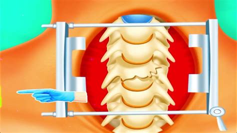 Neck Surgery Cervical Laminoplasty Life Care Tv1 Youtube