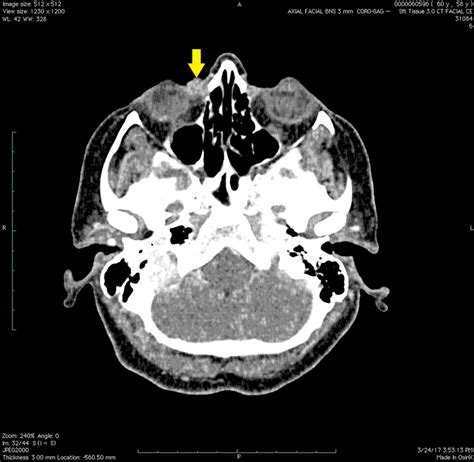 A Non Contrast Ct Scan Showing A Well Circumscribed Hyperintense