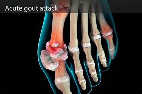 What Is Gouty Arthritis Inflammation Academy
