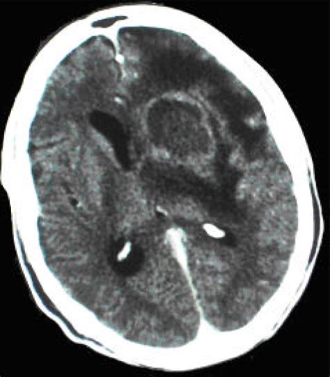 Ct Scan Post Contrast Of Patient Dd Showing A Nodular Ring Enhancing Download Scientific