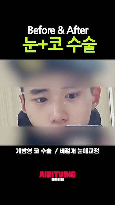 [수술전후] 개방형 코 수술 비절개 눈매교정 올리팅성형외과 Shorts 눈성형 코성형 Youtube