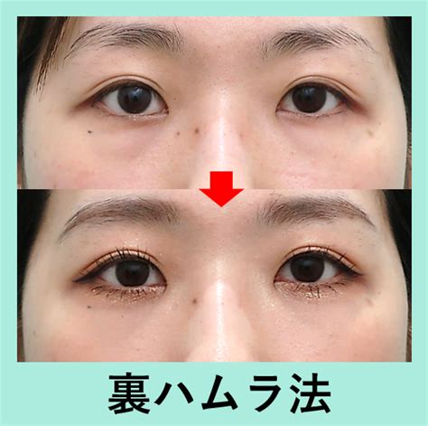 目の下の窪みやクマが気になるけど、脂肪注入は嫌！という方は裏ハムラがお勧めです 東京・銀座の美容外科クリニック｜wom Clinic Ginza