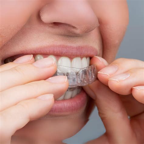 Invisalign Myths Debunked What You Really Need To Know