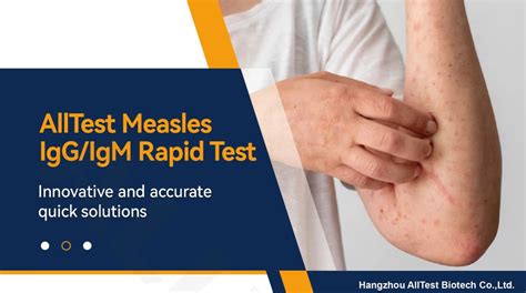1 X Measles Igg Lgm Rapid Test Hibernia Medical