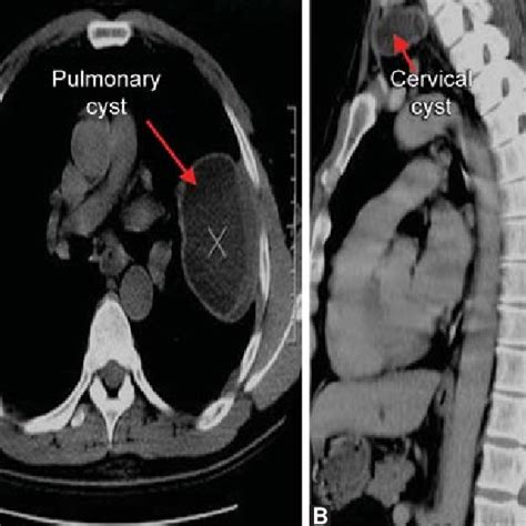 Intraoperative Photo Of The Cervical Hydatid Cyst Download Scientific