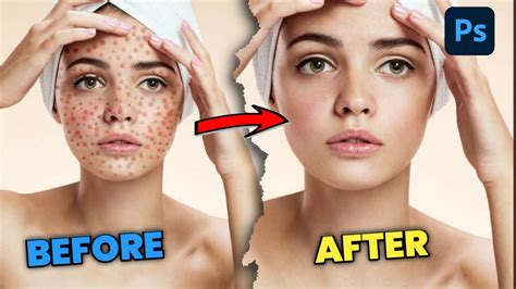 How To Remove Acne And Pimples In Photoshop Cc 2015 Photoshop