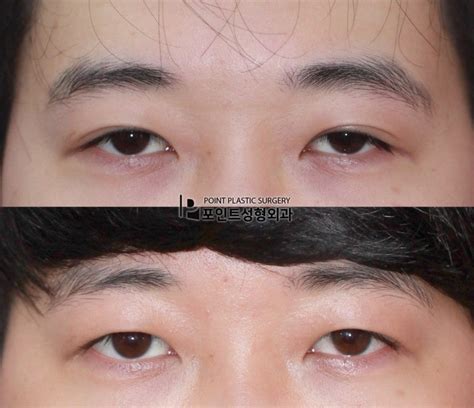 【二重整形症例男性】男性二重除去、男性一重目つき矯正の症例 韓国ポイント整形外科