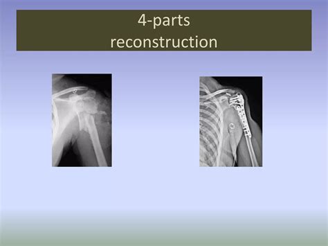 Neglected Proximal Humerus Fractures A Surgical Challenge Dr Mohamed Ashraf Hod Orthopaedics