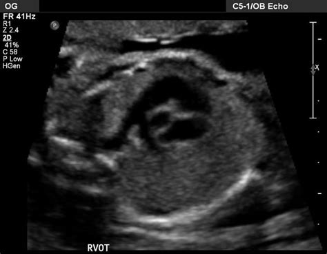 Left Ventricular Outflow Tract View Fetal Echocardiogram Radiology