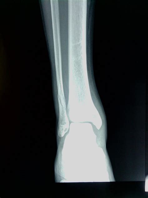 Foot Muscle Forces And Deformities Foot And Ankle Orthobullets