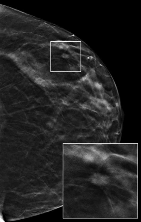Imaging Features Of Nonmalignant And Malignant Architectural Distortion Detected By