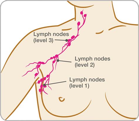 How To Identify Cancerous Lymph Nodes Cancerwalls