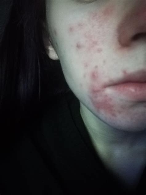 Before And After Doxycycline Treatment R Acne