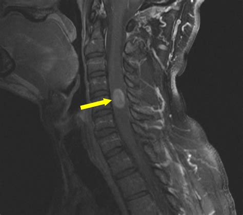 Spinal Ependymoma Typical Radiographic Appearance Adventures In
