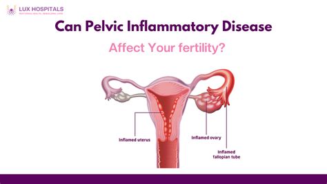 Protect Your Fertility Early Warning Signs Of Pelvic Inflammatory Disease