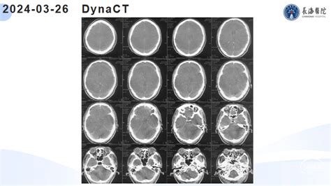 右侧椎动脉闭塞开通术