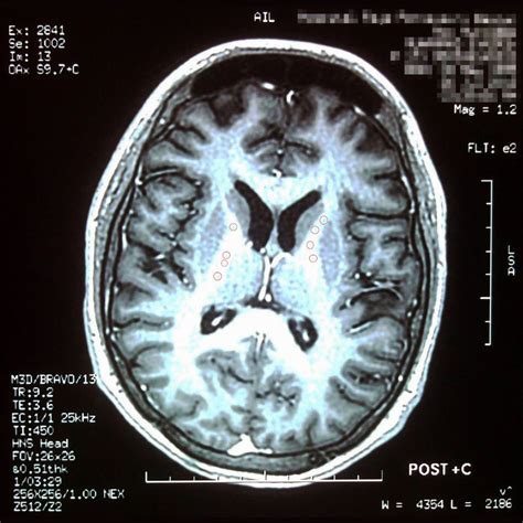 Axial T1w Magnetic Resonance Image Of The Brain Showing Hypointense