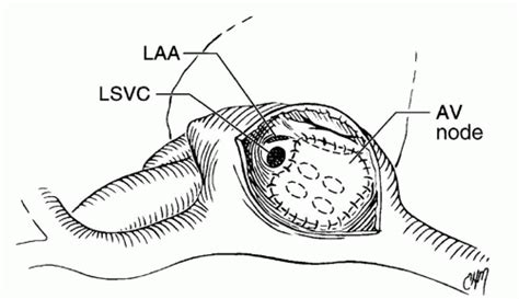 Atrial Septal Defects Thoracic Key