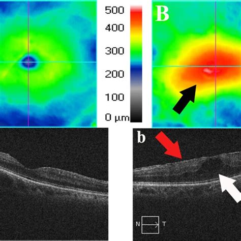 Right Eye With Normal Macula Image A And Left Eye With Abnormal Exam