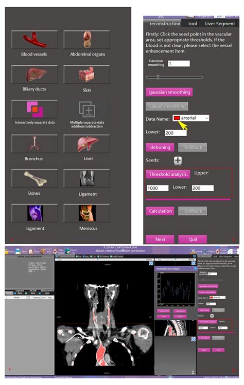 Video Computer Aided Three Dimensional Visualization In The Treatment Of Locally Advanced