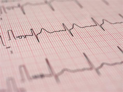 Ectopic Beats Learn What They Are And How You Stop Them