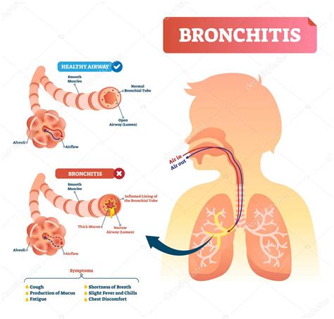 Bronquitis Vector Ilustración Diagnóstico De Enfermedad Pulmonar Con