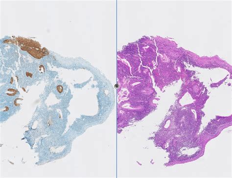 Pathology Outlines P16